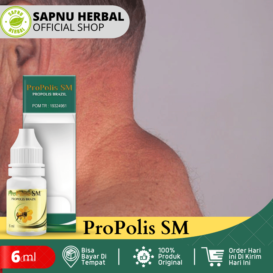 Obat Benjolan Abnormal di Tubuh, Benjolan Lipoma, Kelenjar Getah Bening ...