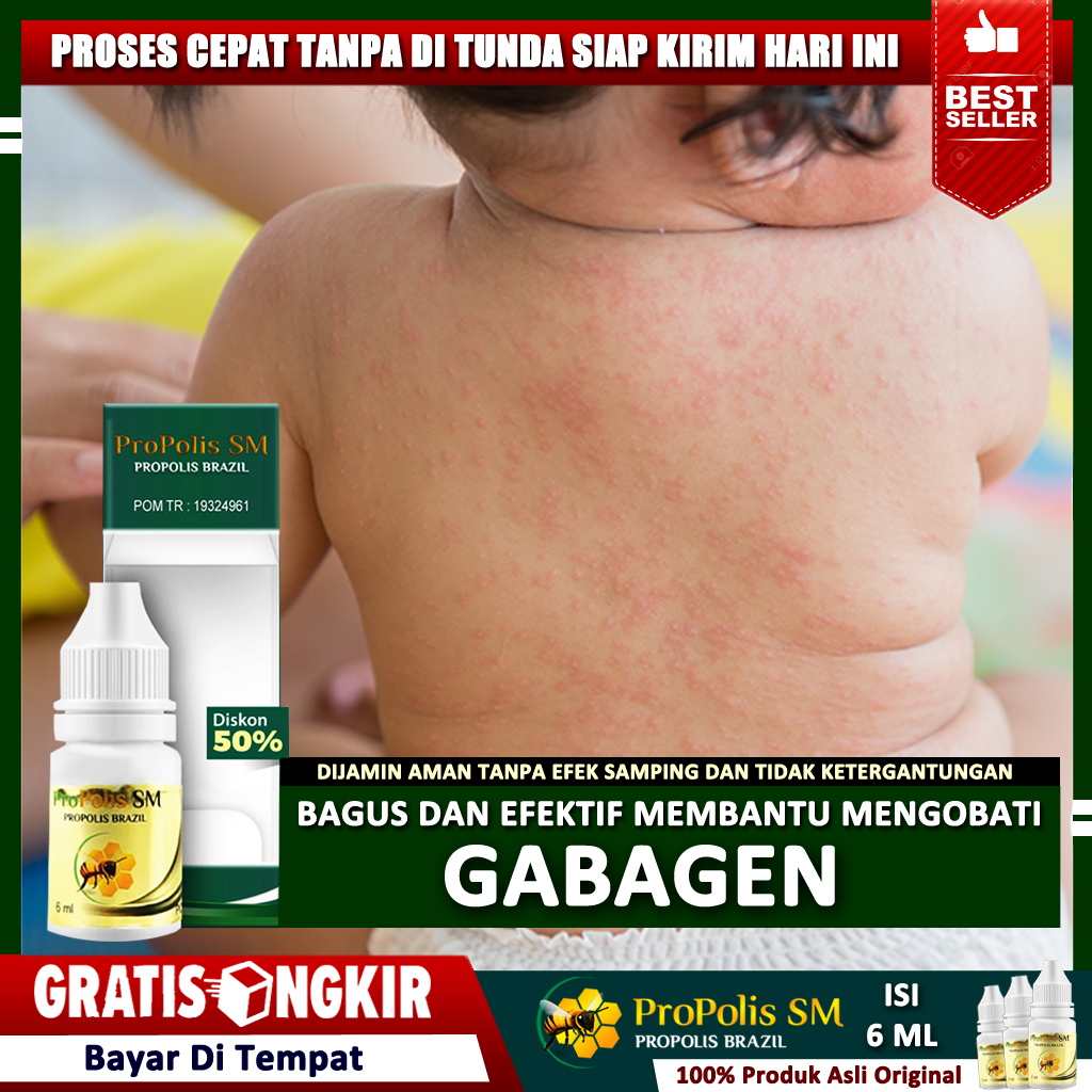 Obat Gabagen, Campak Dewasa, Campak Anak, Penyakit Campak, Gatal Campak ...