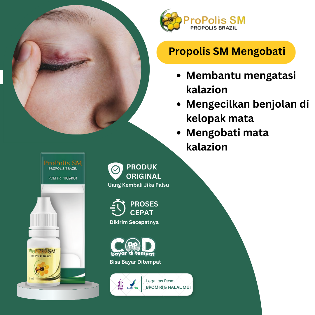 Obat Oles Penghilang Benjolan Di Kelopak Mata Obat Mata Kalazion Mata Bintitan Mata Bengkak