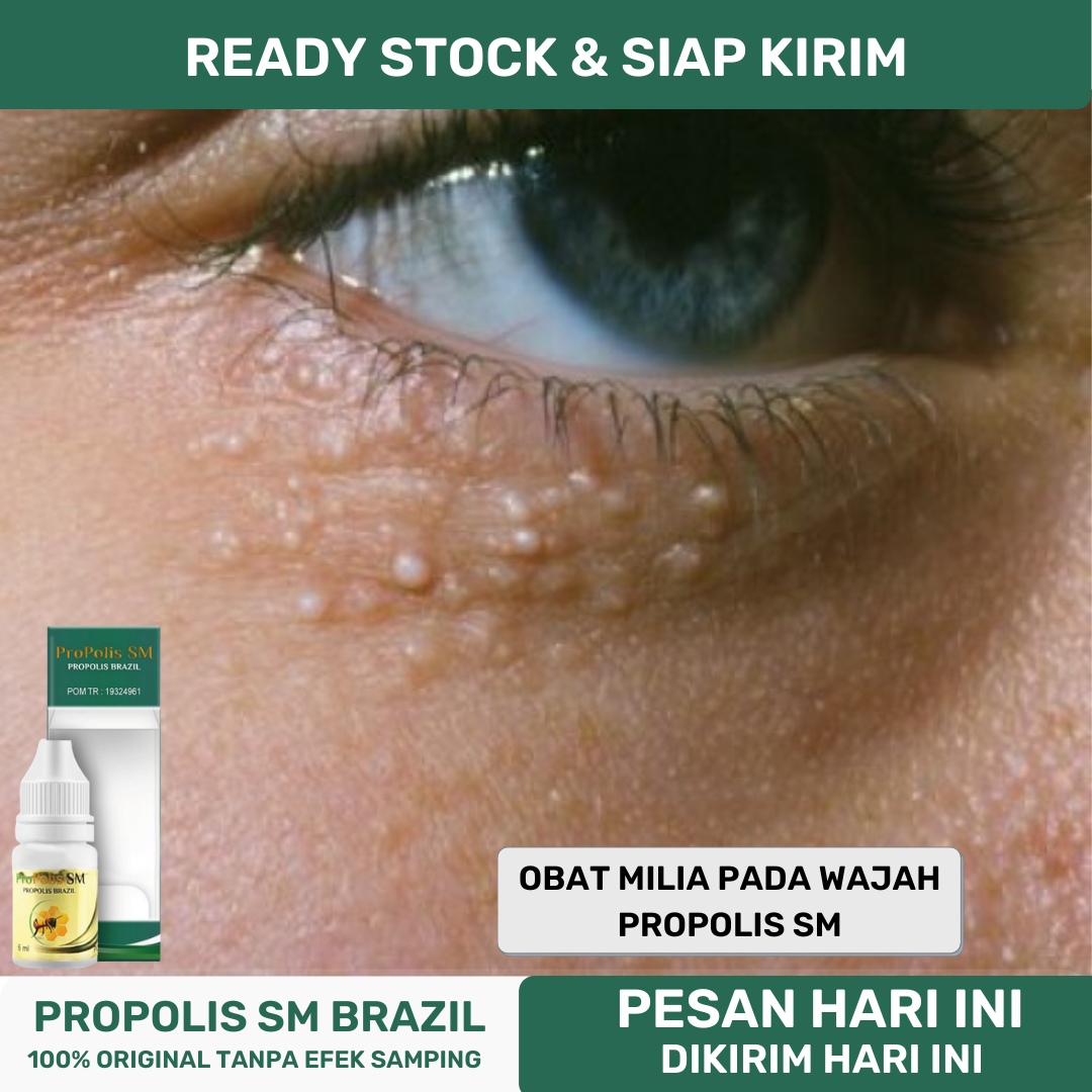 Obat Oles Milia, Obat Milia di Wajah, Obat Milia Di Bawah Mata, Brutusan Bruntusan Kecil Dekat ...