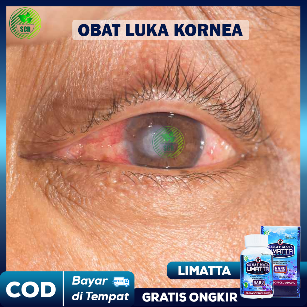 Obat Kornea Mata Robek Luka - Saraf Mata Bengkak Rusak - Mata Keruh ...