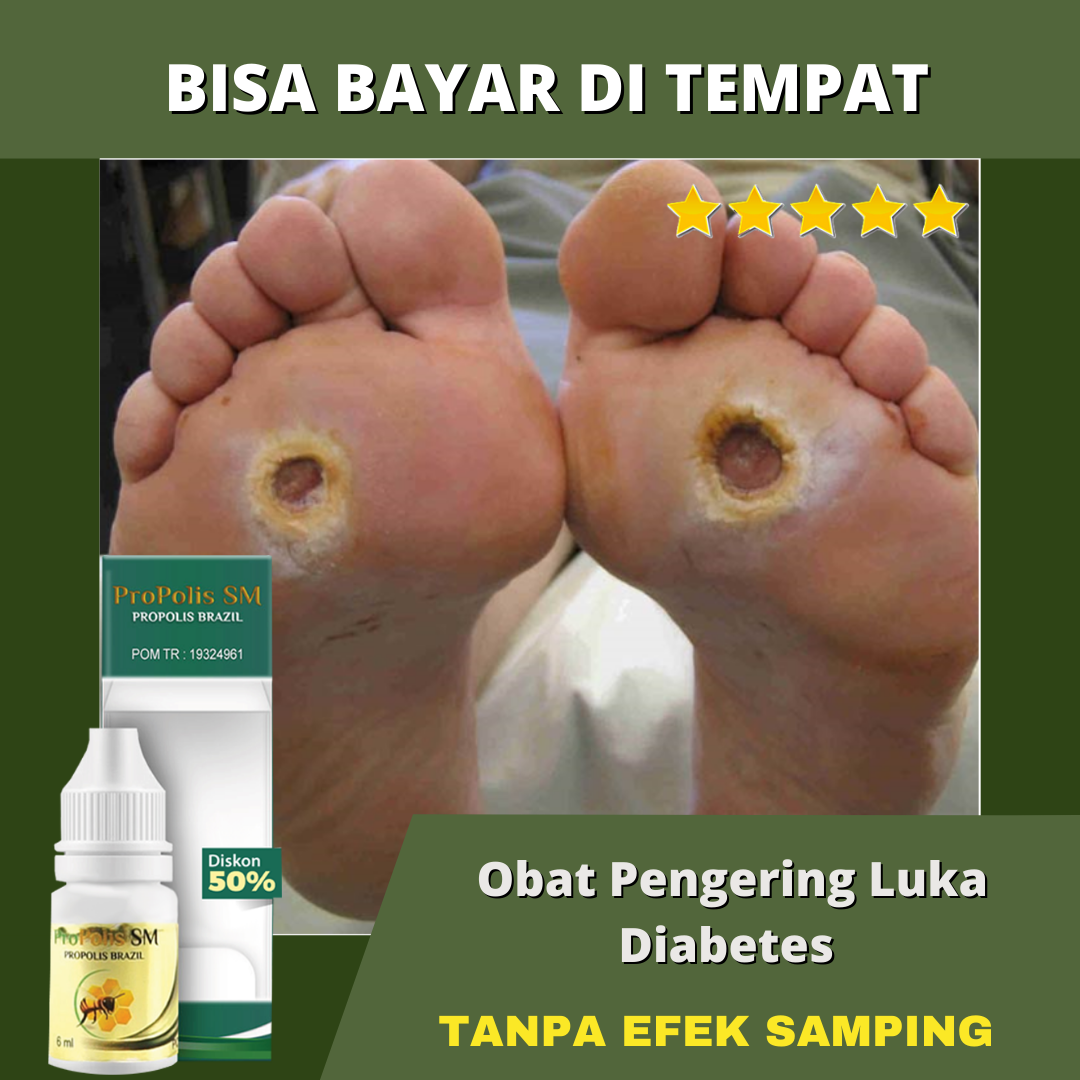 Propolis Brazil SM - Obat Pengering Luka Busuk Diabetes - Luka Diabetes ...