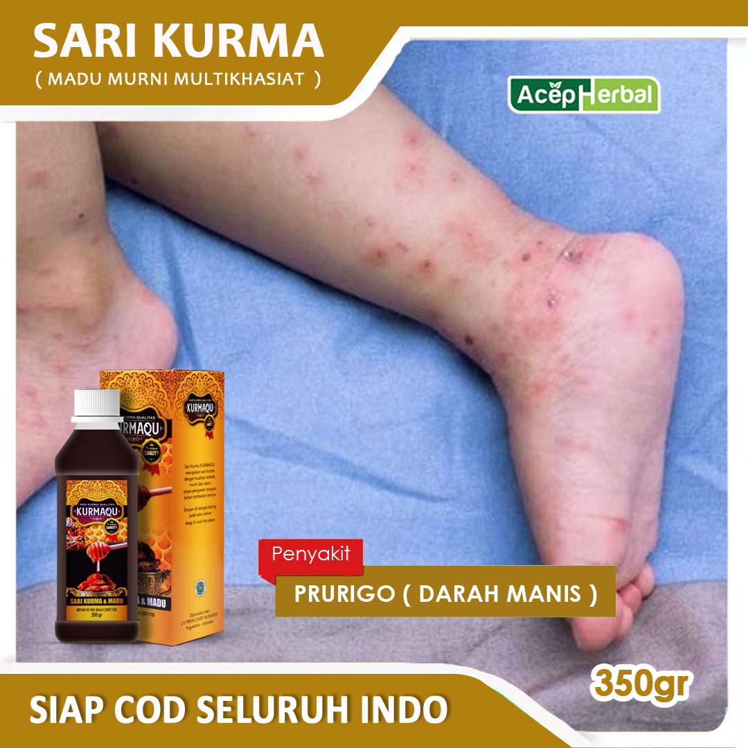 Obat Penyakit Prurigo (Darah Manis) Benjolan Kecil Berwarna Merah Di ...