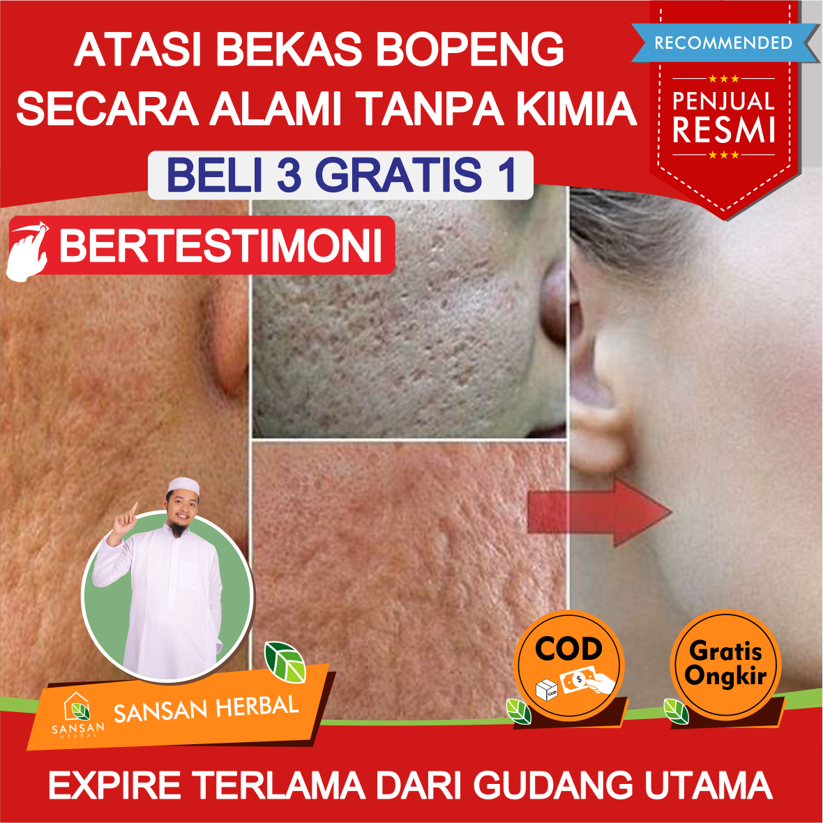 Sabun Pembersih Bopeng Bekas Jerawat, Sabun Penghilang Bopeng Di Apotik ...