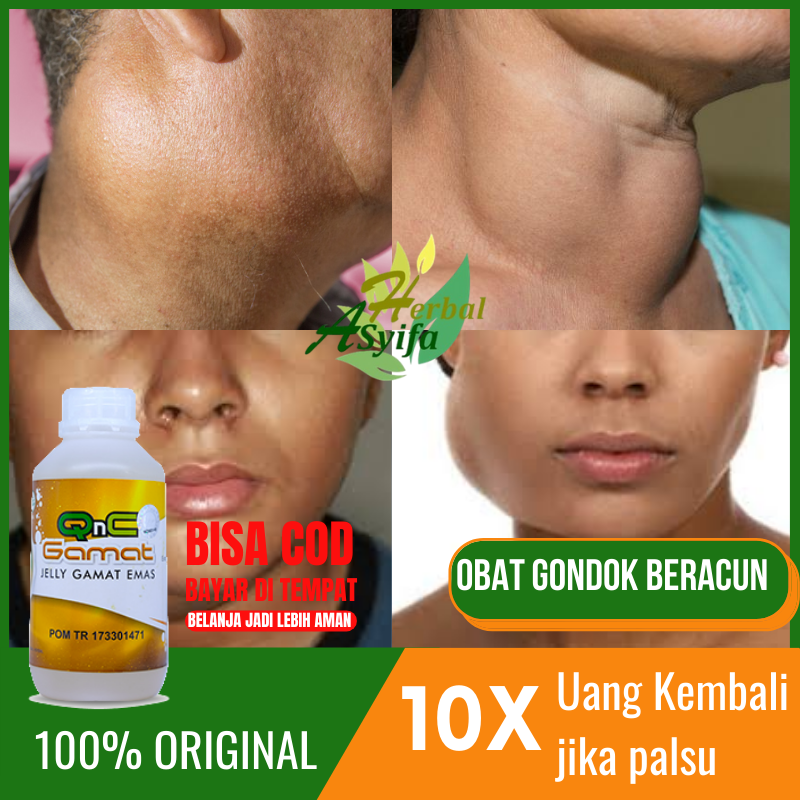 Obat Gondok di Leher Beracun - Kelenjar Tiroid, Toksik Goiter, Obat ...