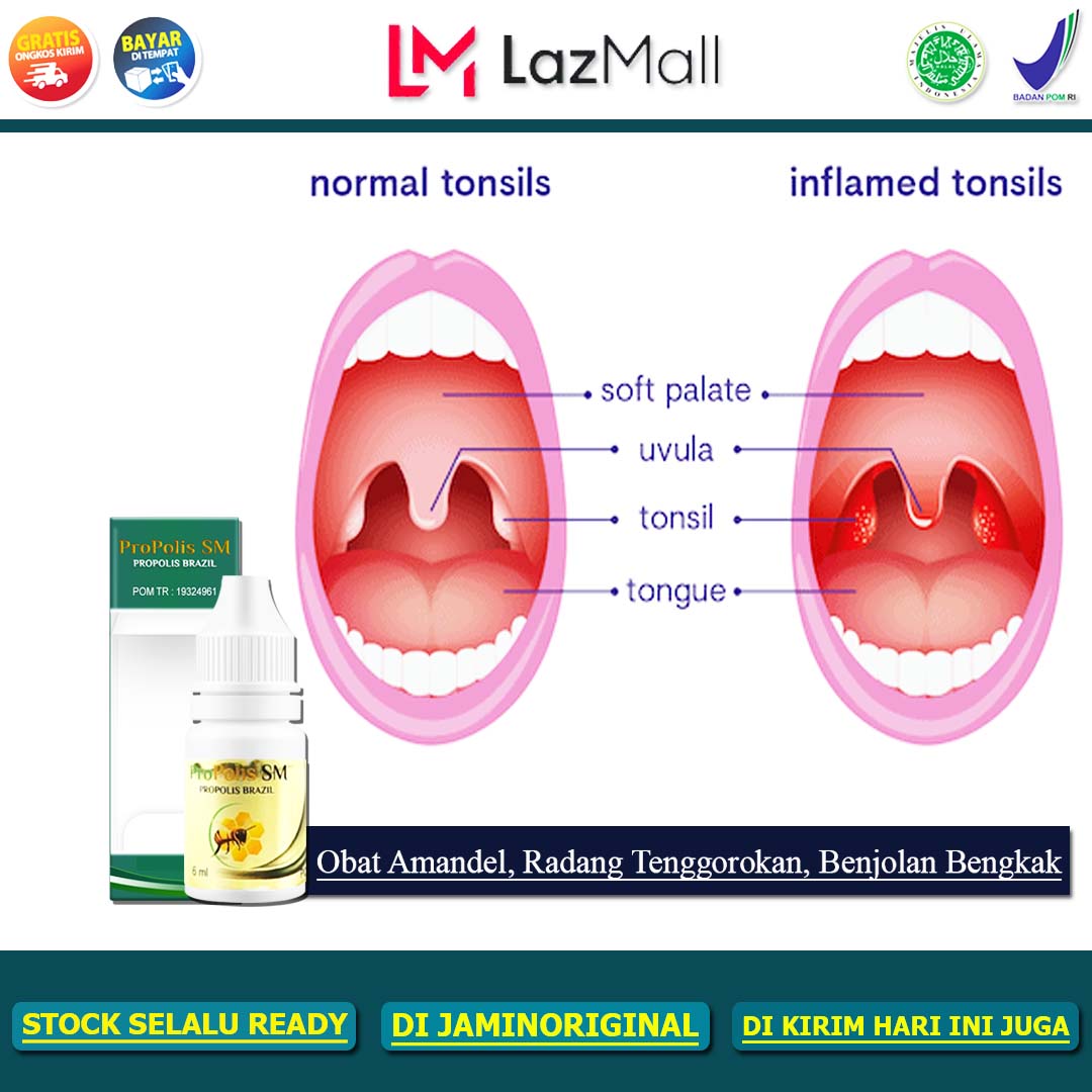 Porpolis SM Obat Amandel Parah Tanpa Operasi - Obat Amandel Bengkak ...