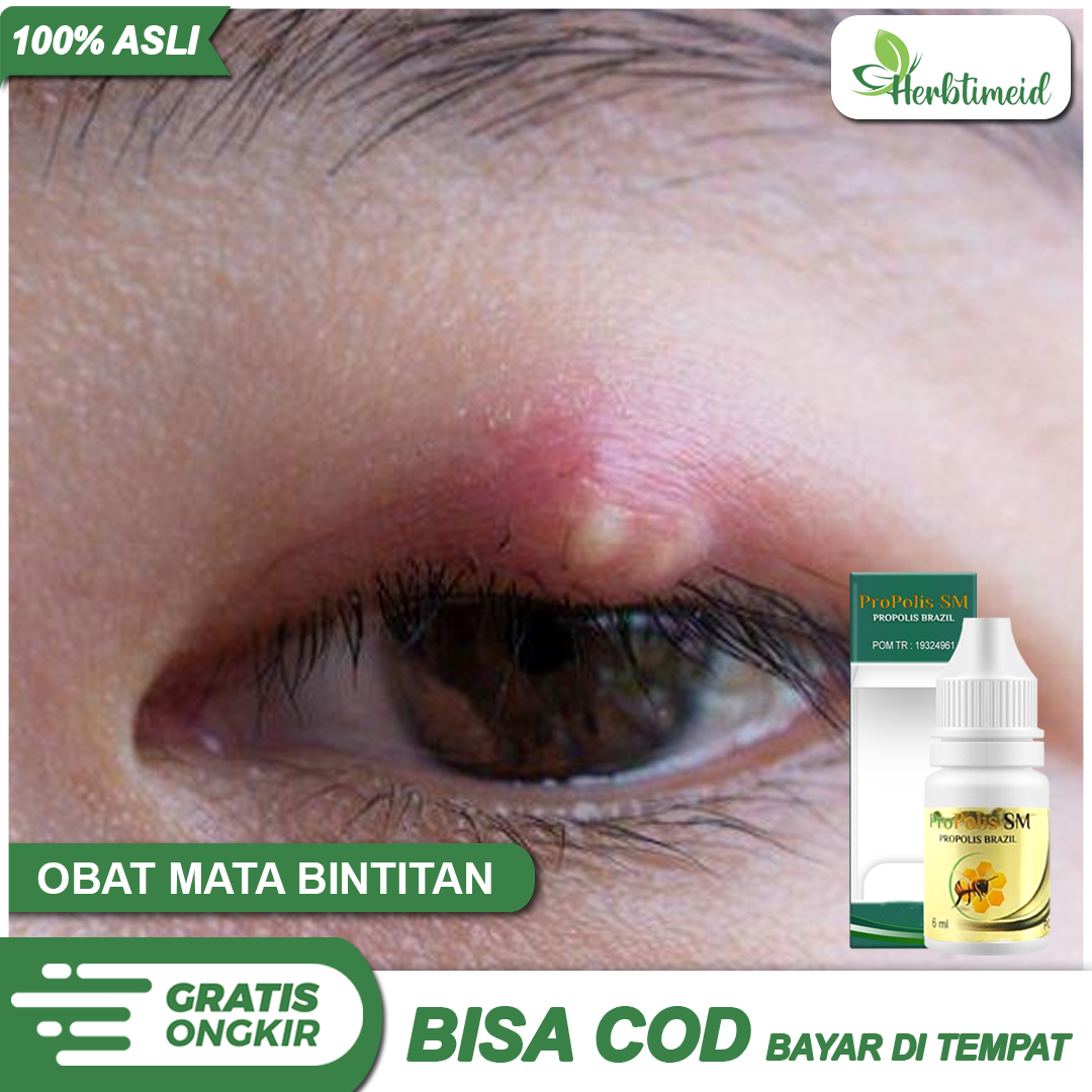 Obat Mata Bintitan - Benjolan di Kelopak Mata Atas - Salep Mata ...