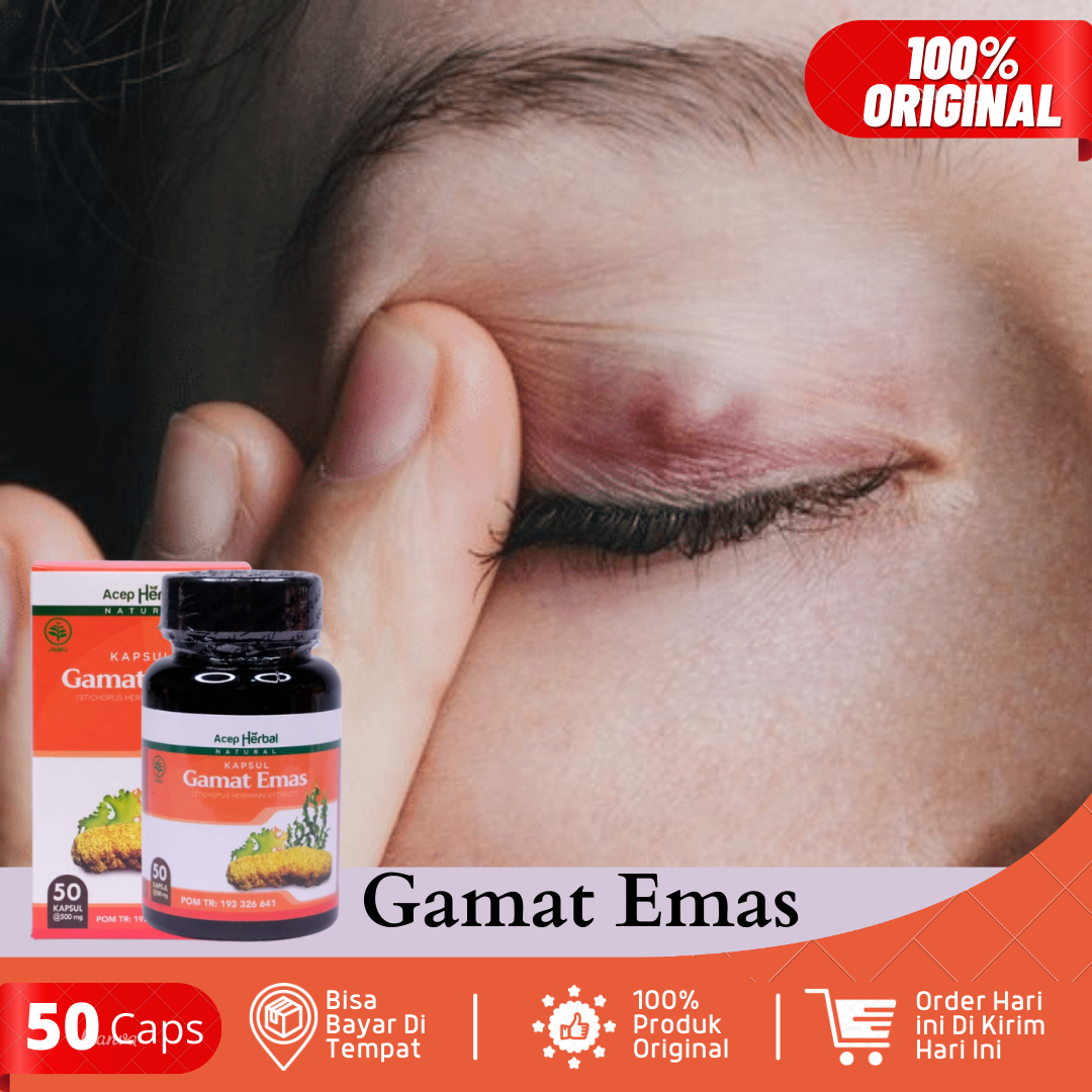 Obat Mata Bintitan, Mata Kalazion, Benjolan di Kelopak Mata, Penghilang ...