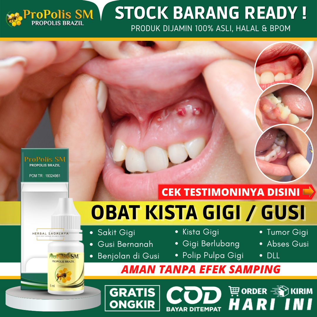 OBAT KISTA GIGI - OBAT BENJOLAN DI GUSI - PENGHILANG BENJOLAN DI GIGI ...