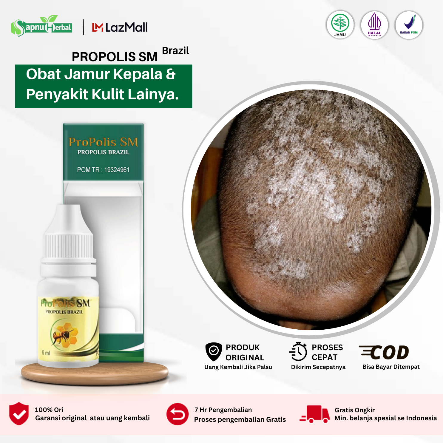 Obat Jamur Kulit Kepala, Tinea Kapitis, Kurap Di Kepala | Lazada Indonesia
