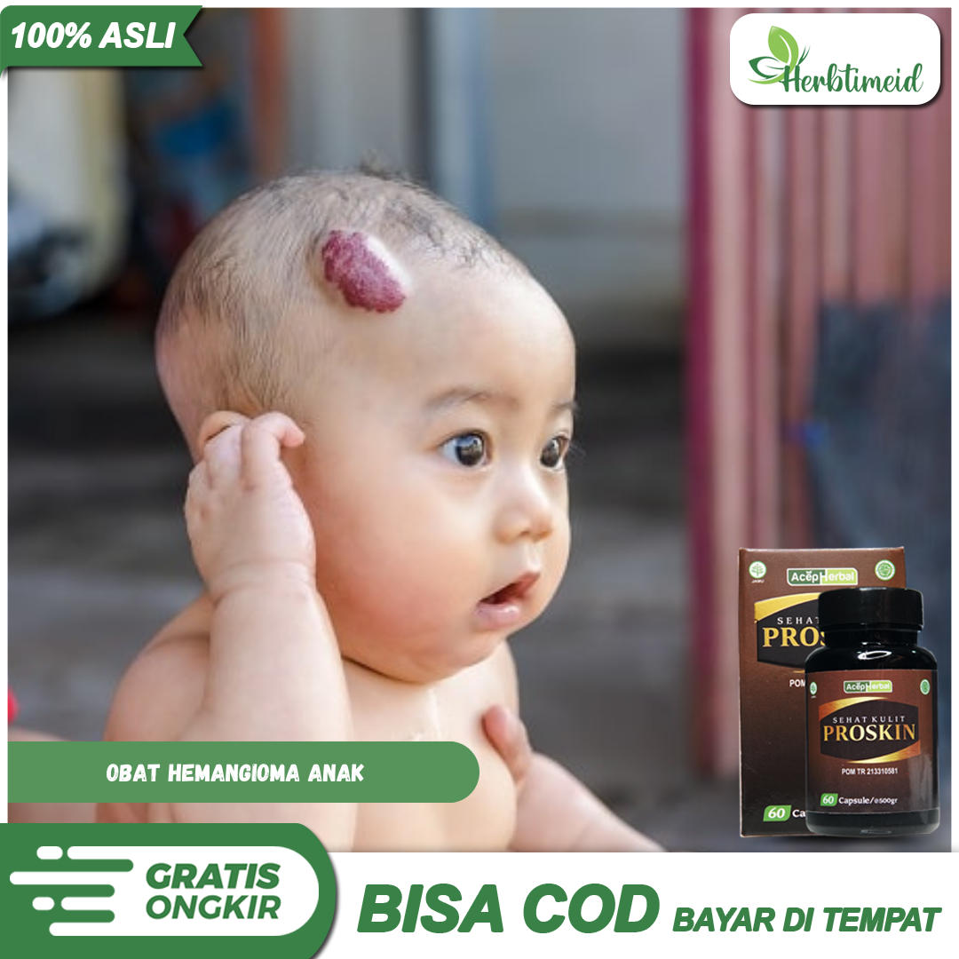 Obat Hemangioma pada bayi/Benjolan Hemangioma/Hemangioma Infantil/Obat ...
