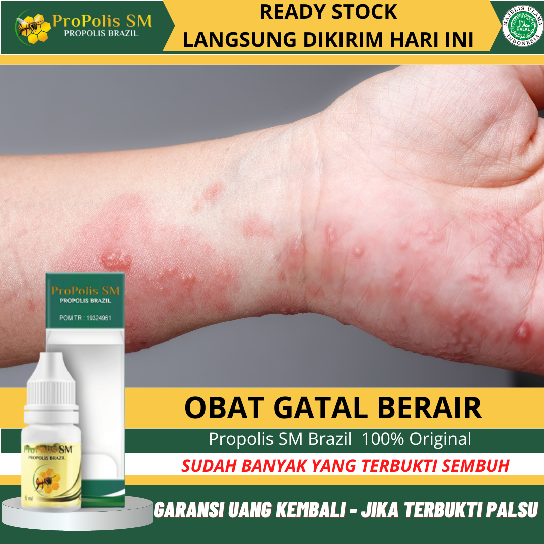 Obat Gatal Di Jari Tangan Dan Kaki, Obat Gatal Bintik Berair Di Telapak ...