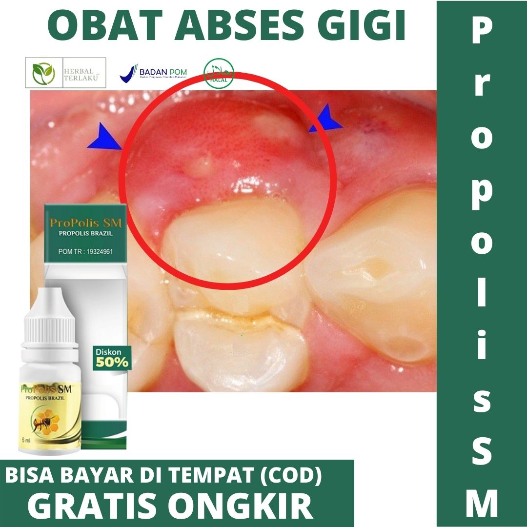 Obat Abses Gigi herbal termurah , Gusi Bengkak , Bernanah , Benjolan ...