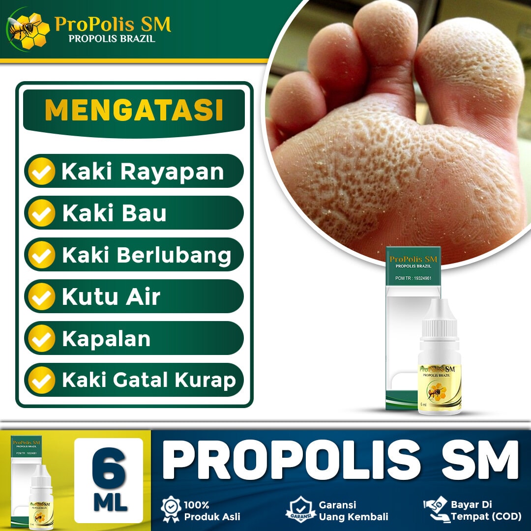 Obat Kaki Rayapan Dan Bau, Kaki Rayapan Berlubang, Telapak Kaki Bolong ...