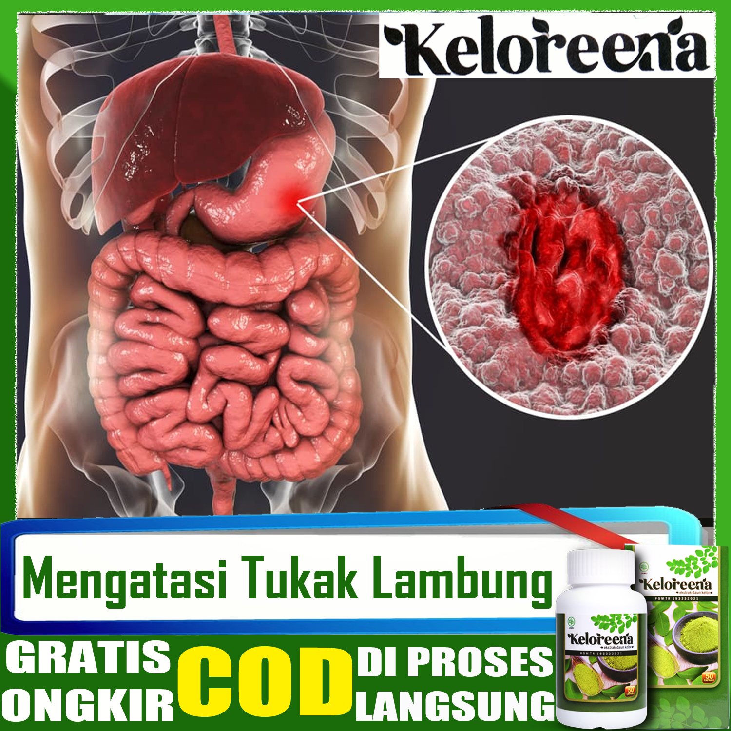 Obat Tukak Lambung Asam Lambung Lambung Bocor Cedera Dinding Lambung Tukak Lambung Ringan