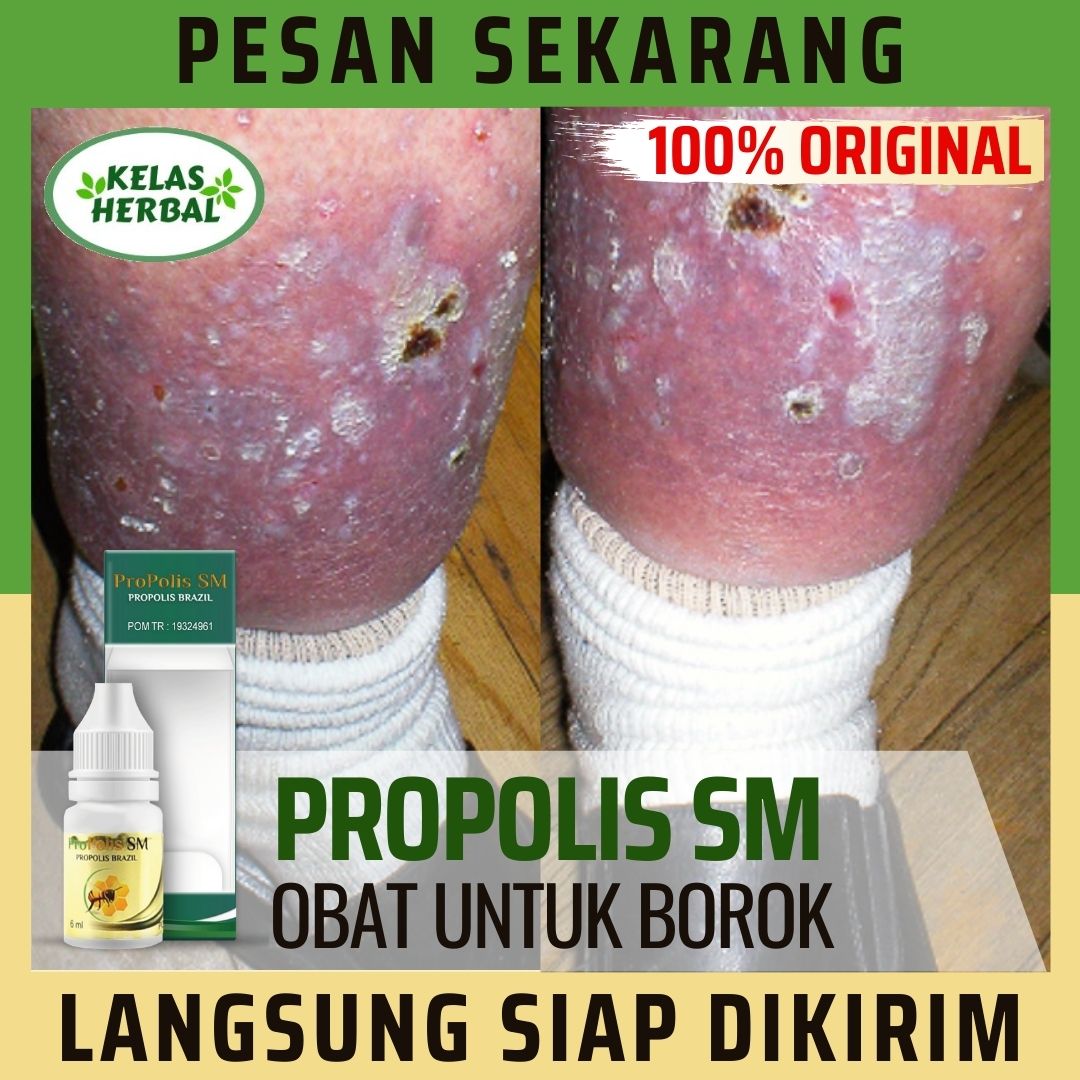 Obat Cair untuk Borok - Obat Kulit Borok Bernanah, Obat Borok Kering ...