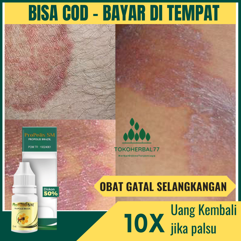 PROPOLIS SM BRAZILIAN ASLI - OBAT SELANGKANGAN PAHA BAYI LEMBAB & GATAL ...