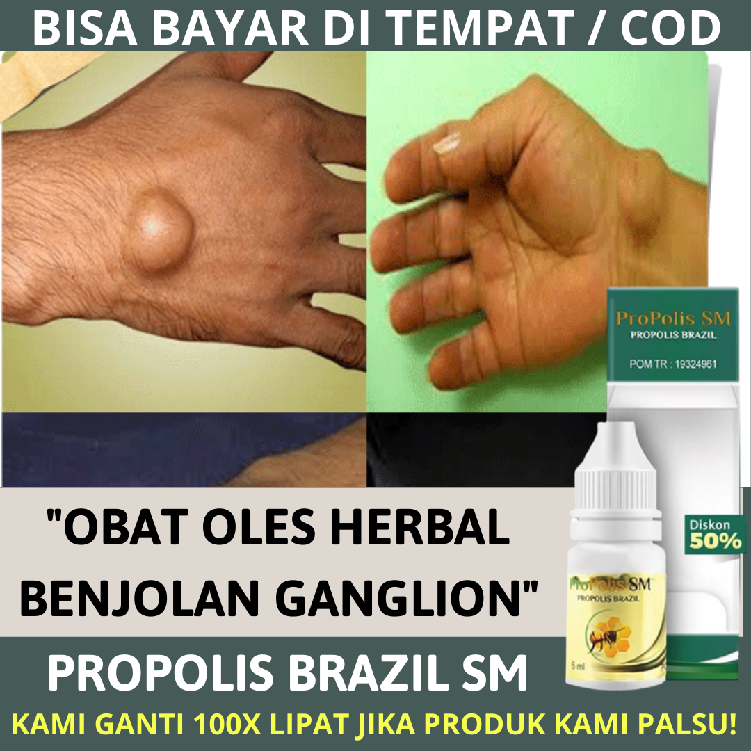 Obat Oles Penghancur Benjolan Ganglion - Obat Benjolan Ganglion ...