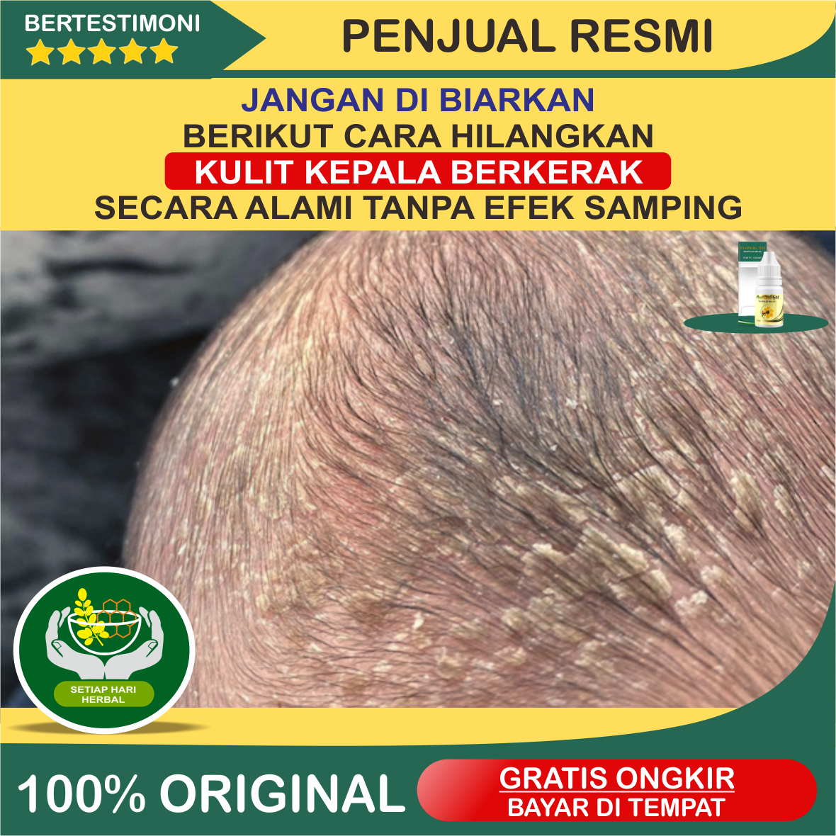 PROPOLIS SM Salep Anti Jamur Untuk Kulit Kepala Berkerak, Obat Untuk ... PROPOLIS SM Salep Anti Jamur Untuk Kulit Kepala Berkerak, Obat Untuk ...