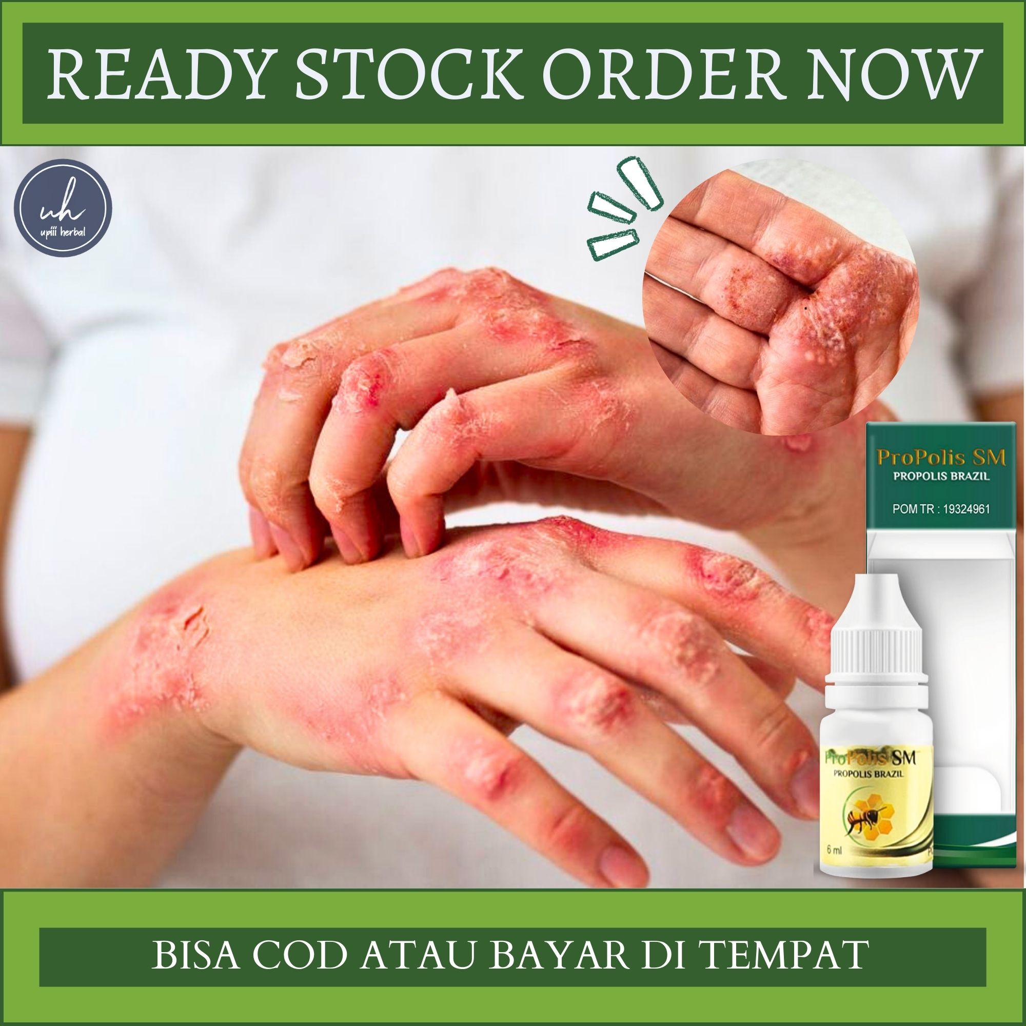 Obat Kutu Air Kaki, Obat Kutu Air Anak, Salep Kutu Air Kaki, Obat Kutu ...