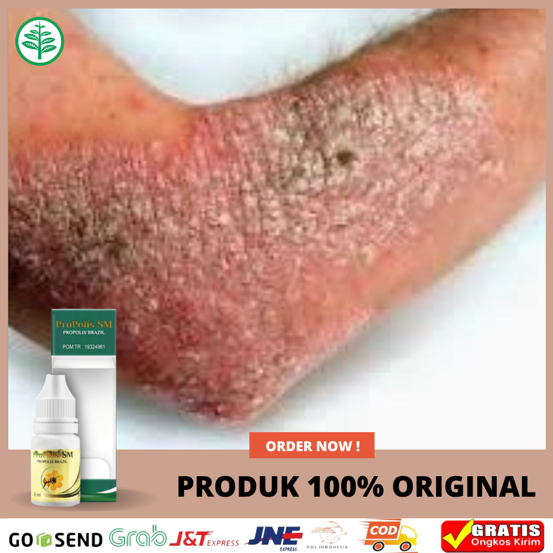 Obat Alergi Semen, Obat Untuk Alergi Semen, Ruam Kemerahan Di Kaki ...