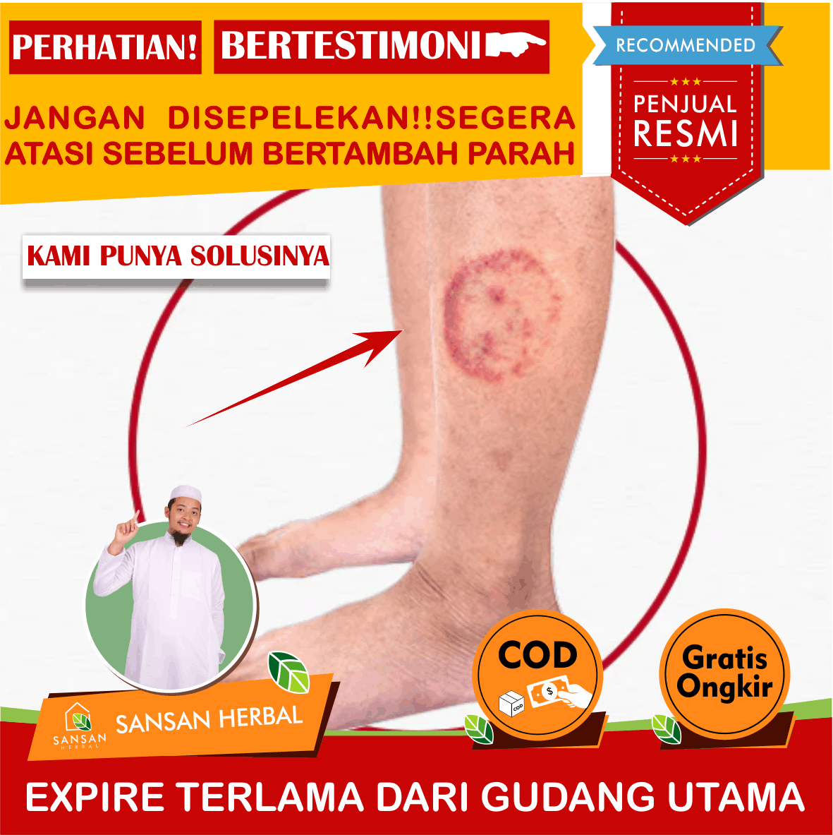 Obat kadass - Obat Gatal Alergi - Borok - Biduran - Herves - Ruam Pada ...