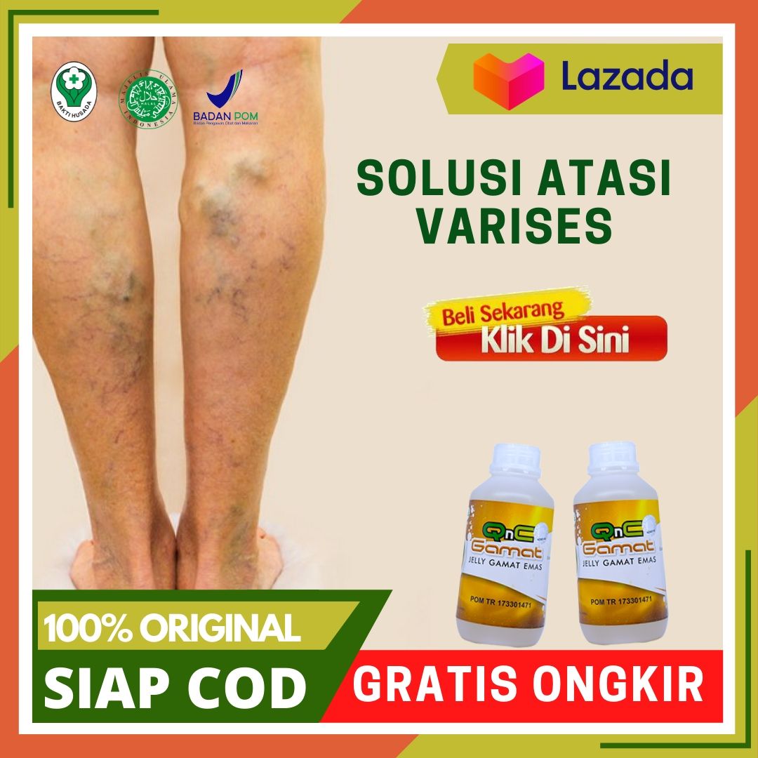 Obat Herbal Varises, Obat Urat Menonjol, Penyempitan Pembuluh Darah ...