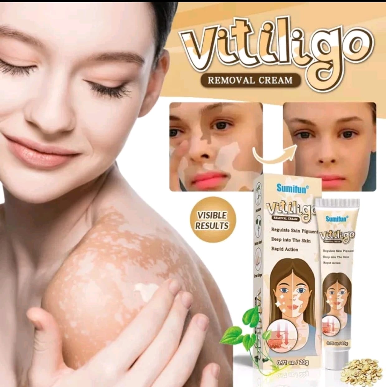 Salep Cream Vitiligo bintik Putih Sumifun - Mengatasi masalah Vitiligo ...