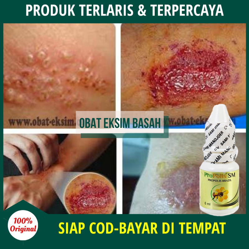 Obat Eksim Basah, Eksim Kulit, Eksim Bernanah, Eksim Gatal Alergi Jamur ...