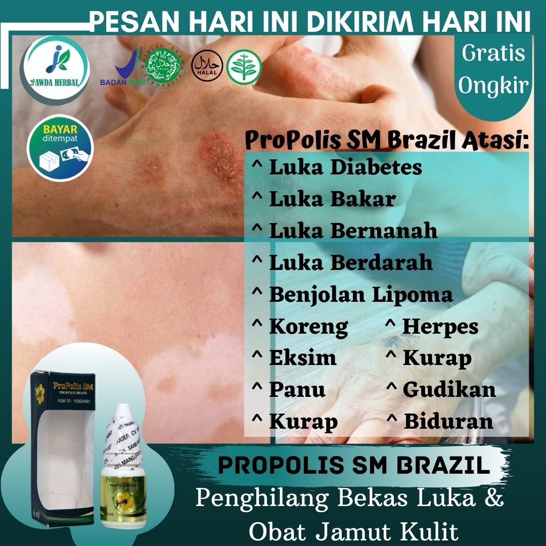 Obat Penghilang Bekas Luka 100% [JH]- Obat Luka Diabetes, Luka Bakar ...