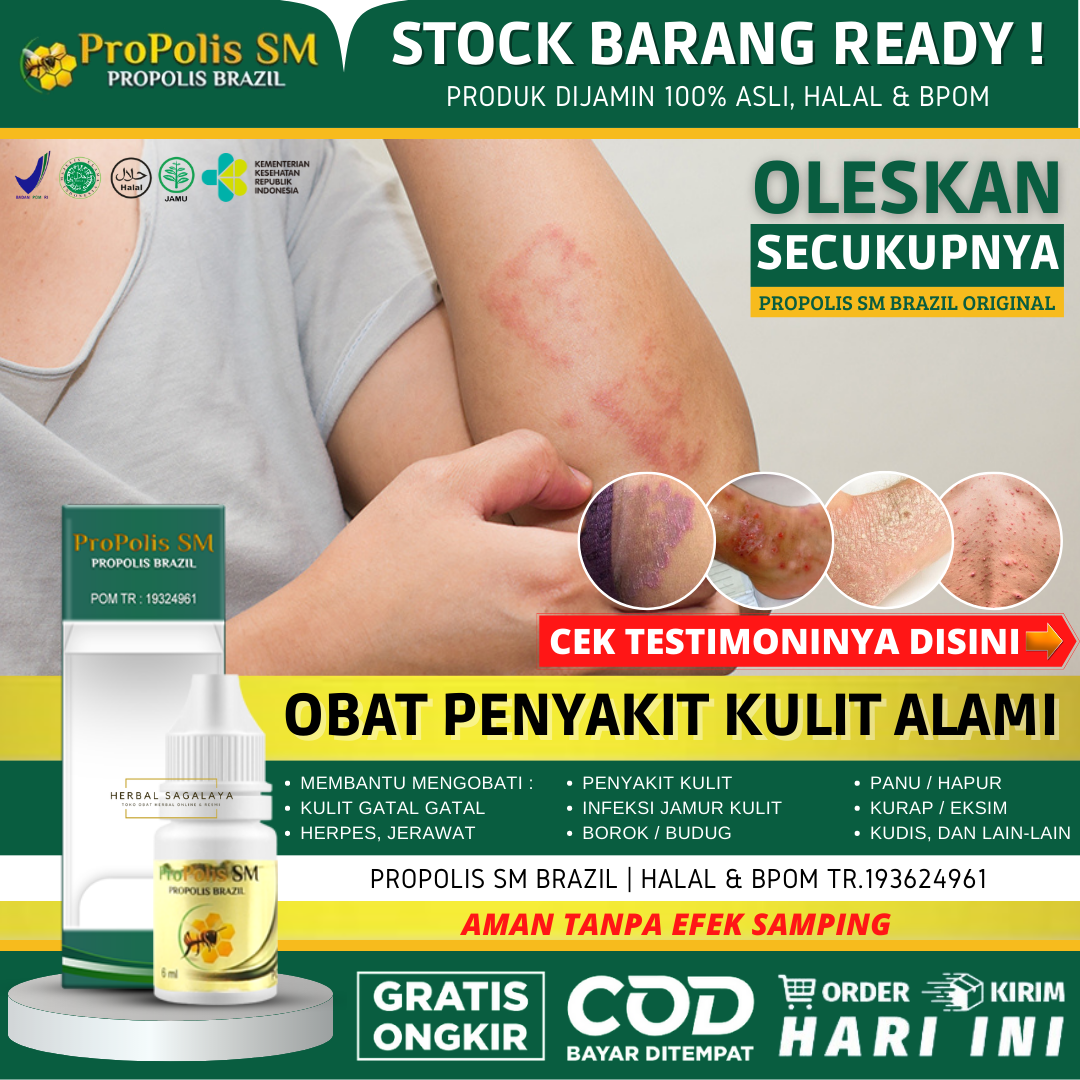 Obat Scabies / Skabies - Obat Kudis Budug Gudig Budukan - Obat Kutu ...