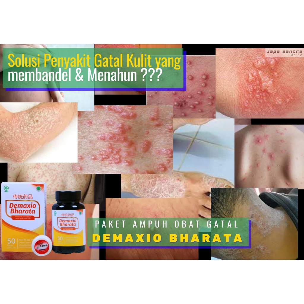 Obat Jamur ,Obat Jamur Pada Selakangan, Obat Jamur Buat Selakangan Obat ...