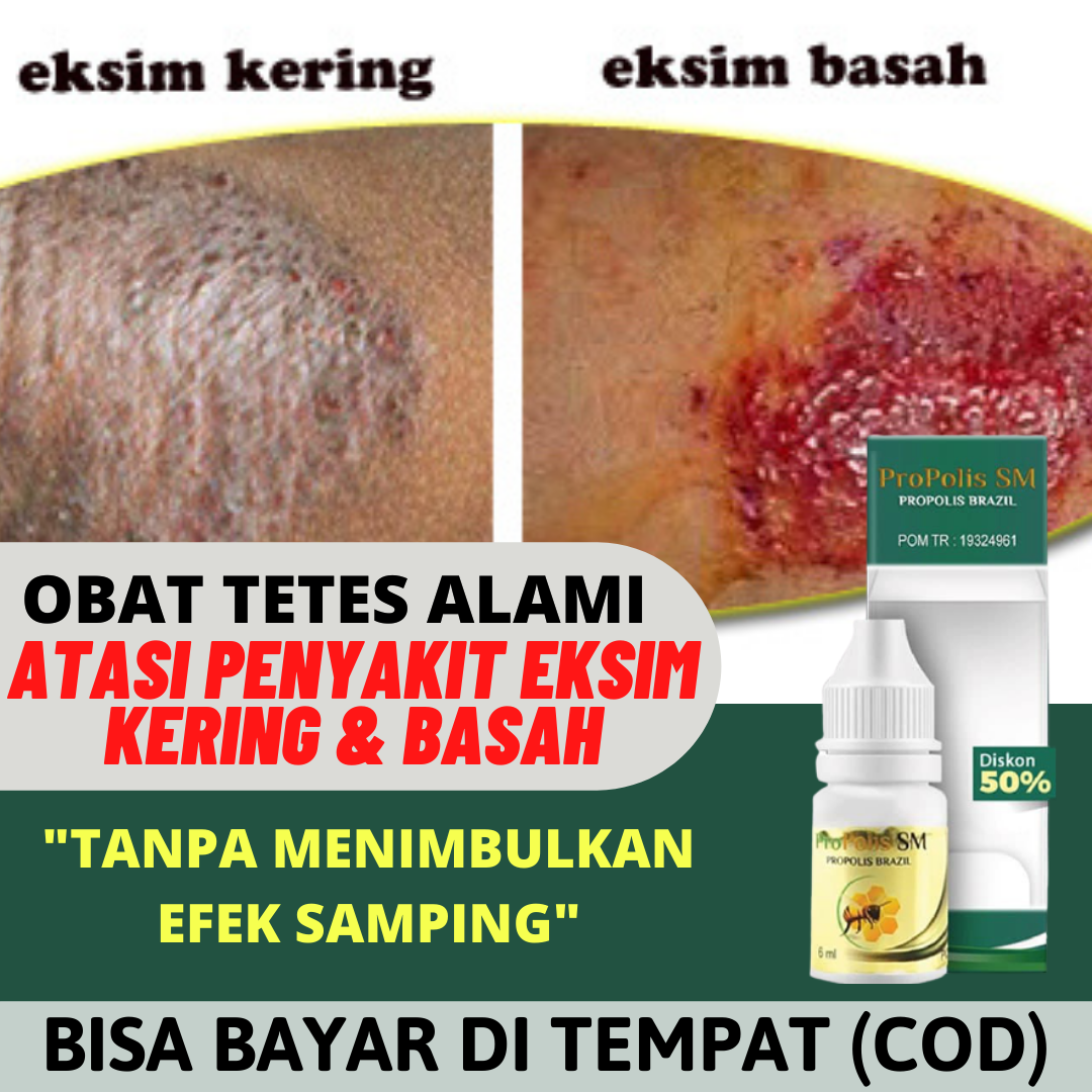 Obat Oles Eksim Kering Atau Basah - Obat Penyakit Kulit Eksem ...
