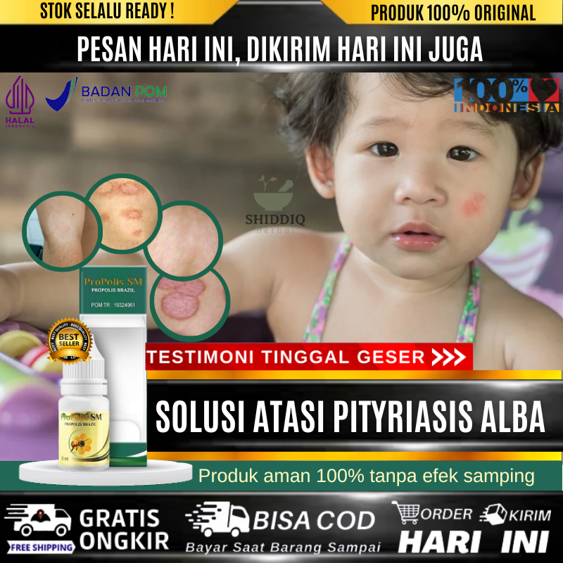 Obat Pityriasis Alba Untuk Anak Dan Dewasa, Penghilang Bercak Merah Di ...