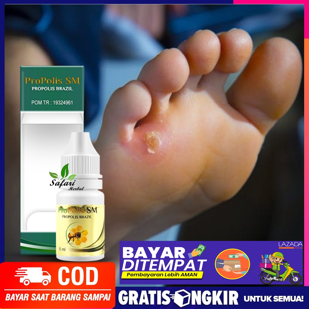 Obat Mata Ikan, Salep Mata Ikan, Penghilang Mata Ikan Di Kaki, Perontok ...