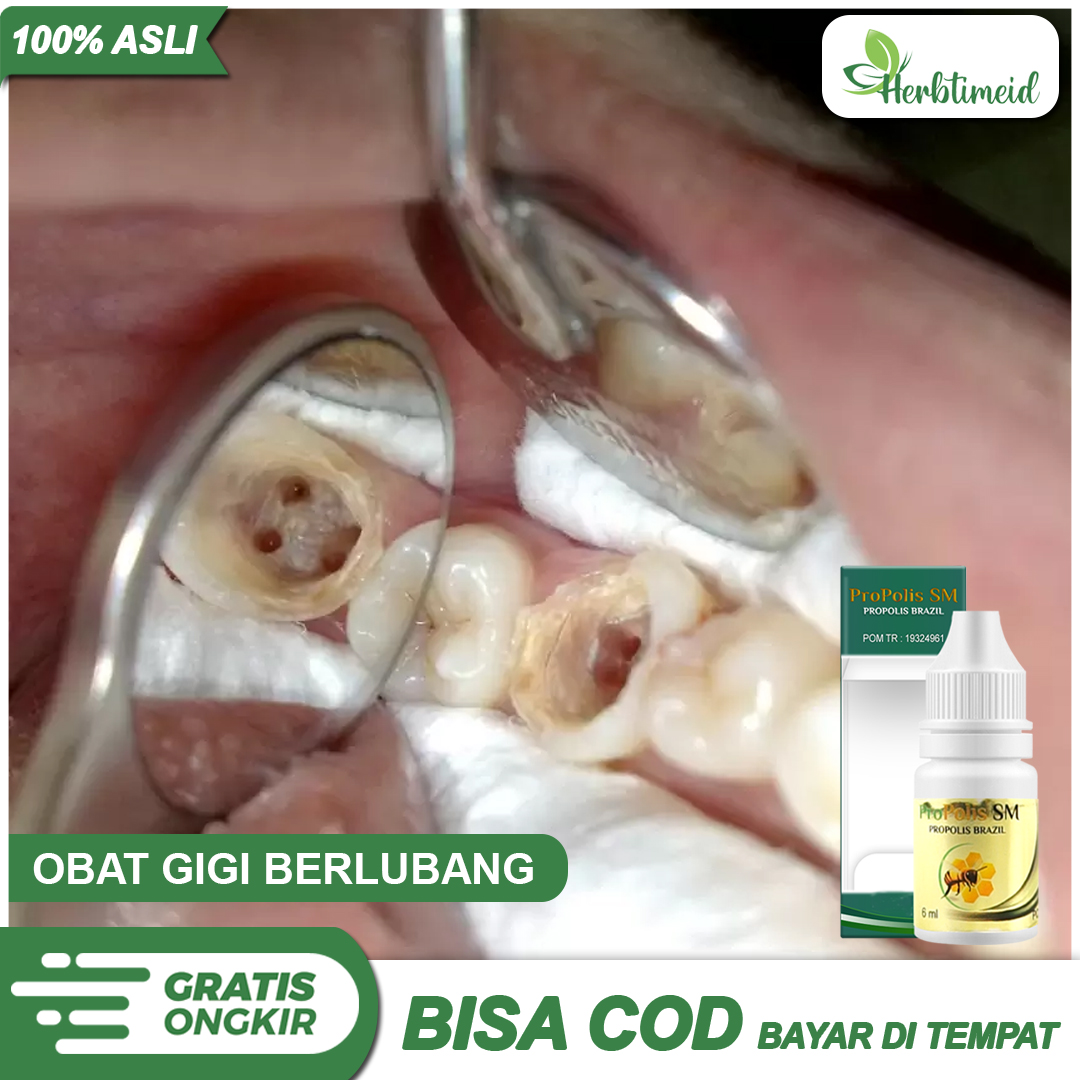 Obat Tetes Gigi Berlubang - Sakit Gigi Bolong Hitam / Gigi Busuk ...
