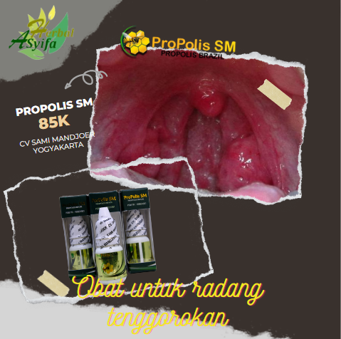 Obat untuk radang tenggorokan, radang tenggorokan dewasa, obat sakit ...