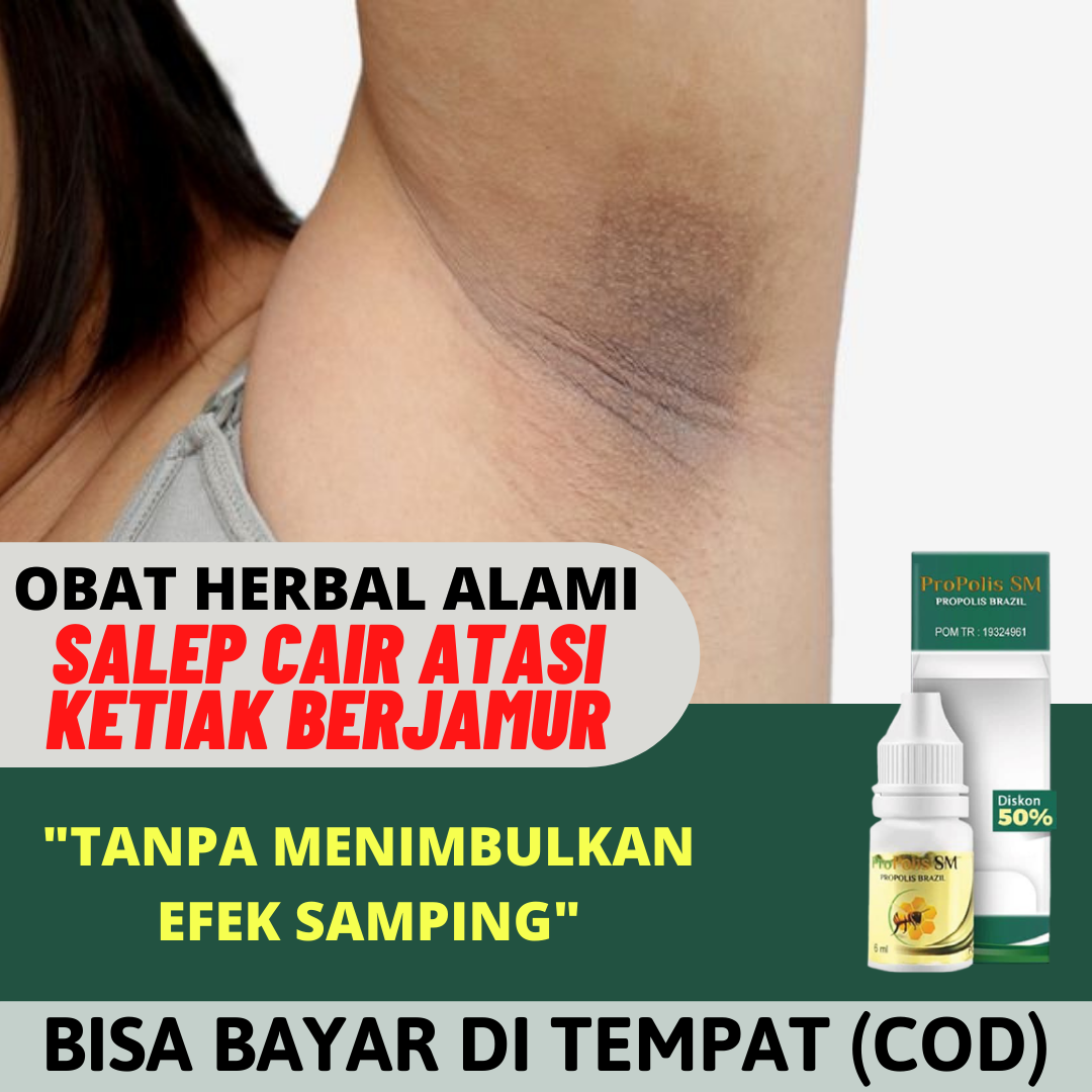 Obat Salep Ketiak Berjamur - Obat Oleskan Infeksi Jamur Di Ketiak Hitam ...