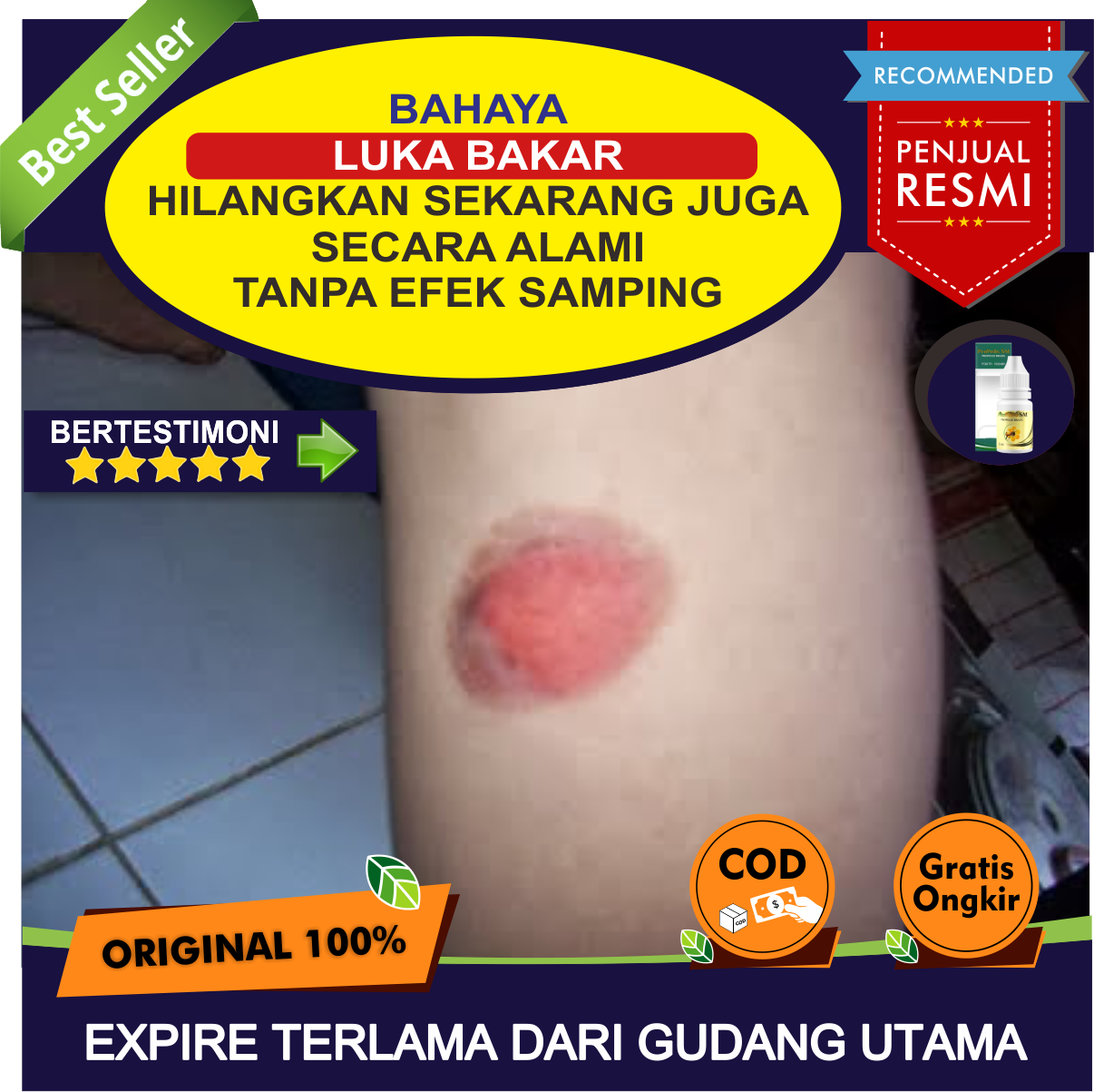 Obat Luka Bakar Knalpot, Obat Alami Luka Bakar Ringan, Obat Luka Bakar Knalpot Pada Anak, Obat ...