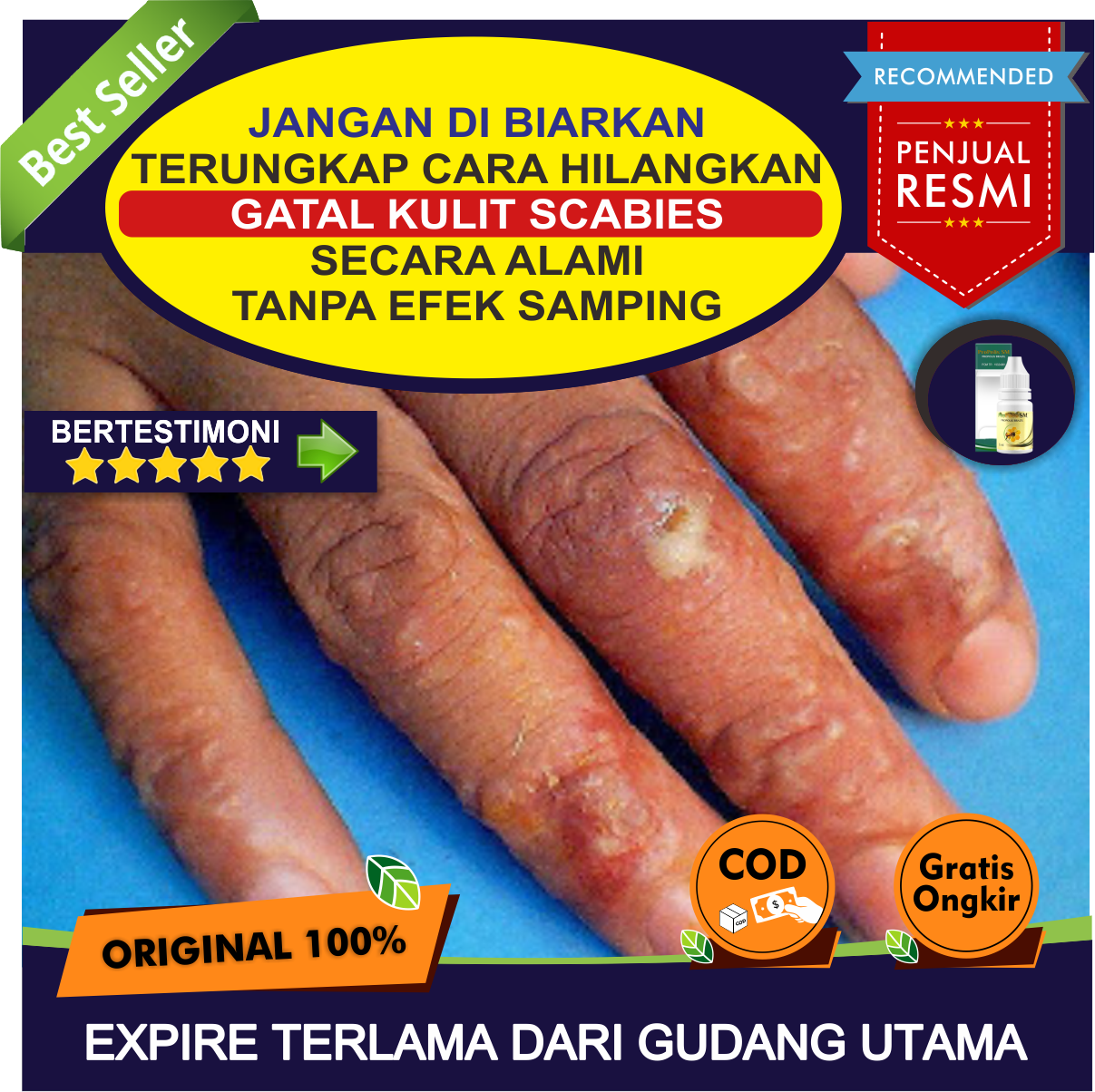 PROPOLIS SM Untuk Gatal Scabies, Obat Salep Scabies Untuk Manusia, Obat ...
