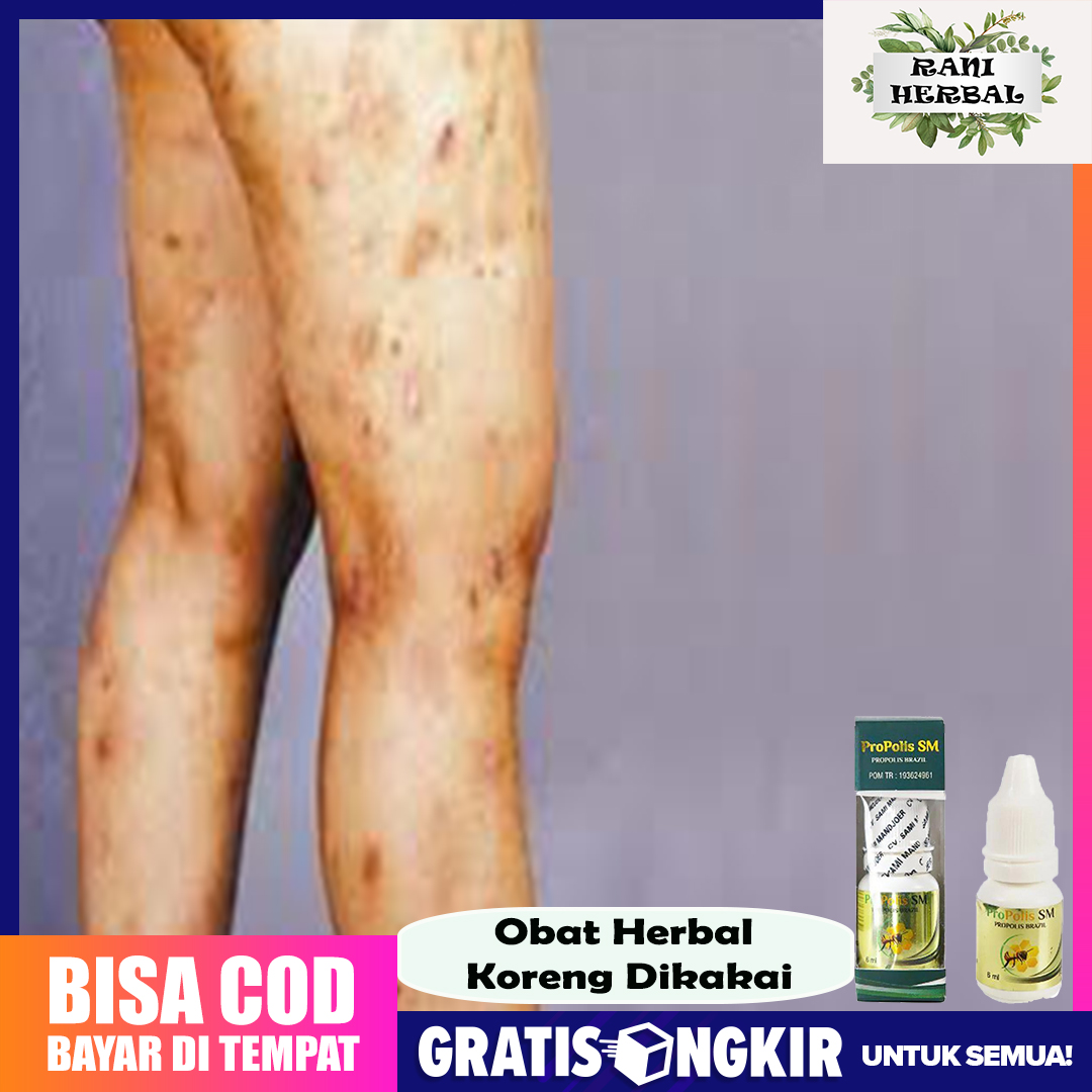 Obat Herbal Koreng, Koreng Di Kaki Dan Tangan, Koreng Alami Propolis ...