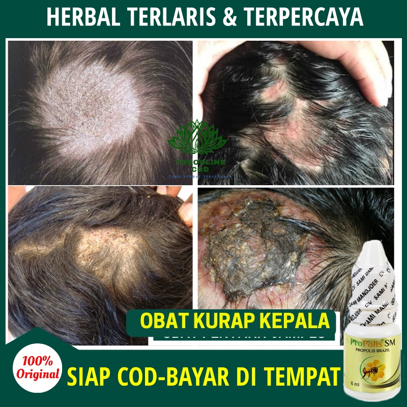 Obat Penghilang Kurap Kepala, Kulit Kepala Berkerak dan Bersisik, Jamur ...
