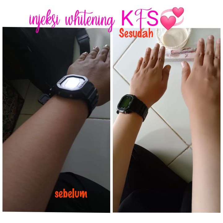 Injeksi Whitening Kfs | Lazada Indonesia