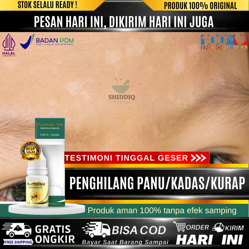 Obat Balas Bogo, Obat Oles Menghilangkan Panu Menahun, Hapuran di Wajah ...
