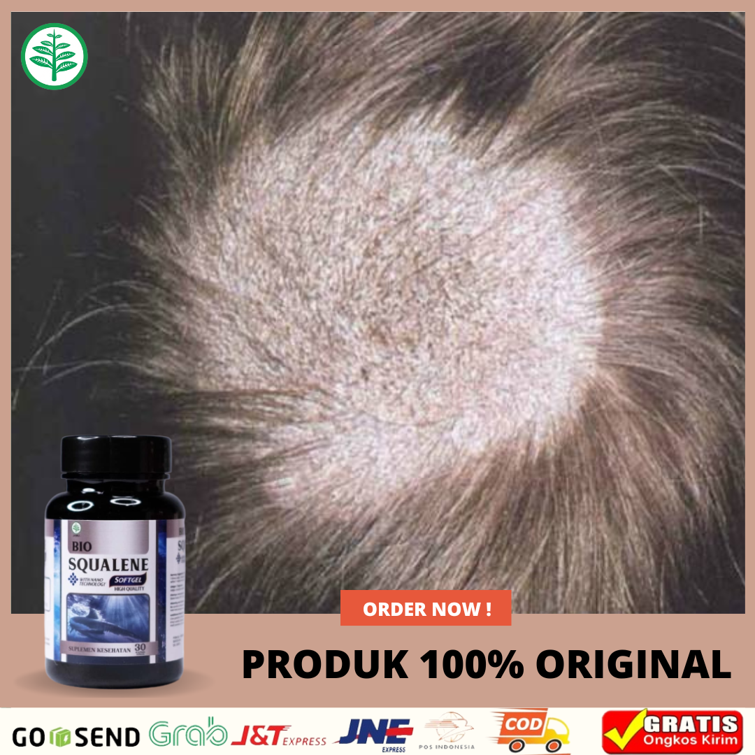 Obat Jamur Kepala ( Tinea Kapitis ), Penghilang Infeksi Jamur di Kepala, Obat Gatal Pada Kulit ...