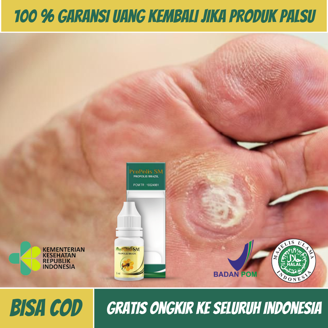 Obat Mata Ikan Di Telapak Kaki Dan Tangan, Obat Tetes Perontok Mata ...