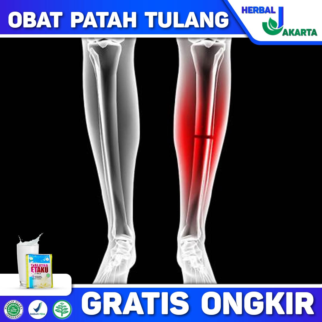Obat Patah Tulang Patah Tulang Belakang Patah Tulang Ekor Patah Tulang Kaki Patah Tulang