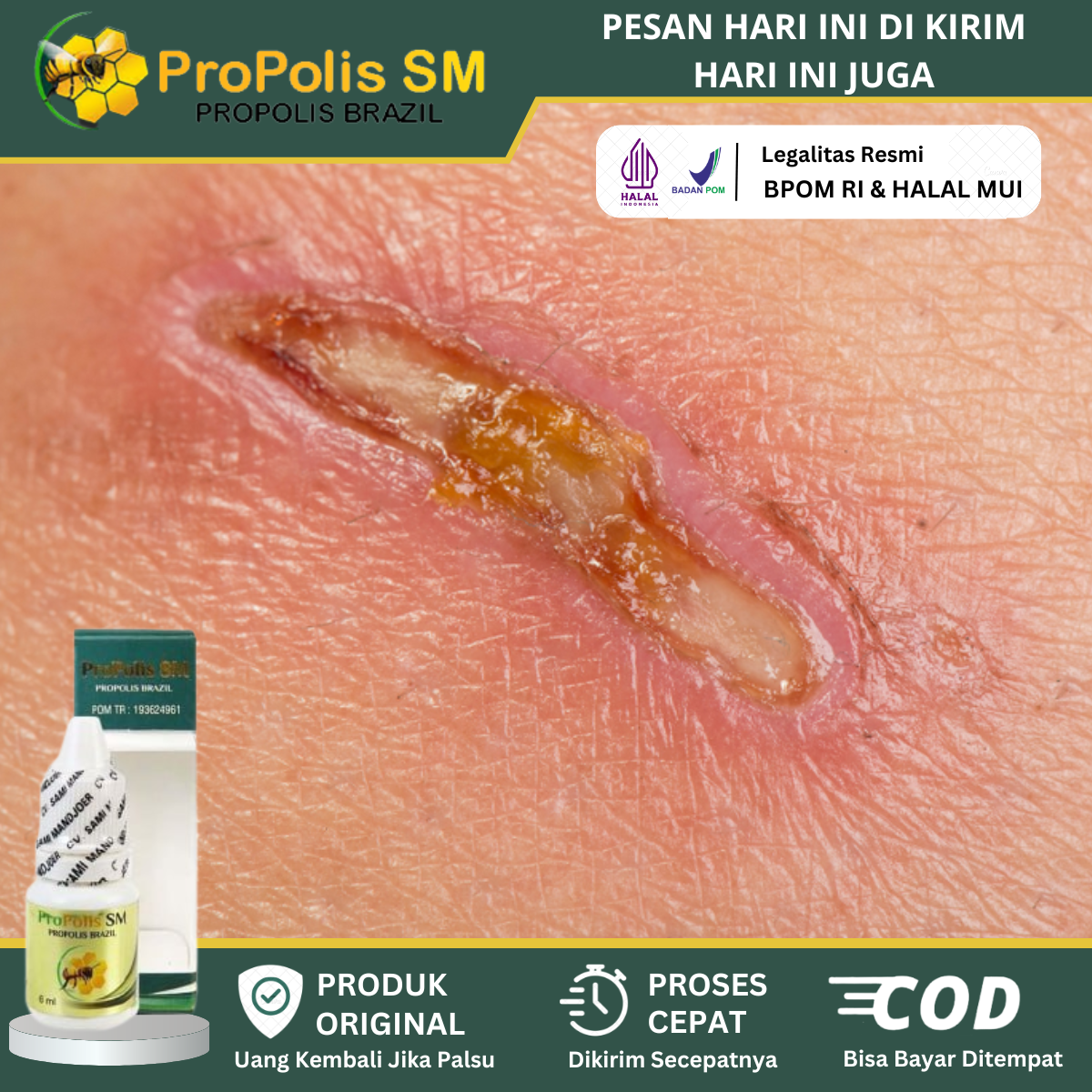 Propolis SM - Obat Pengering Luka Basah Bernanah, Luka Diabetes ...