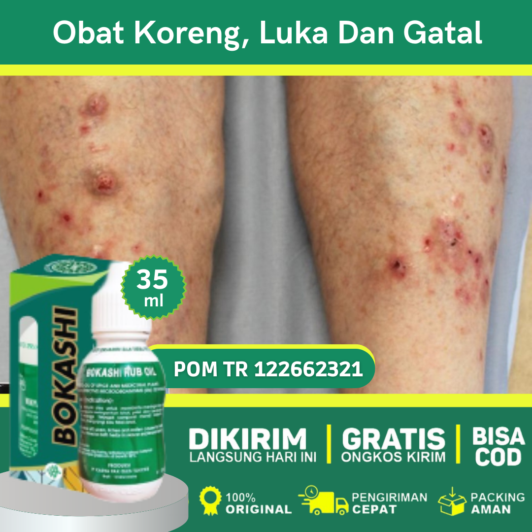 Obat Darah Manis, Gatal Scabies, Kurap, Kudis, Eksim, Jamur, Ruam ...