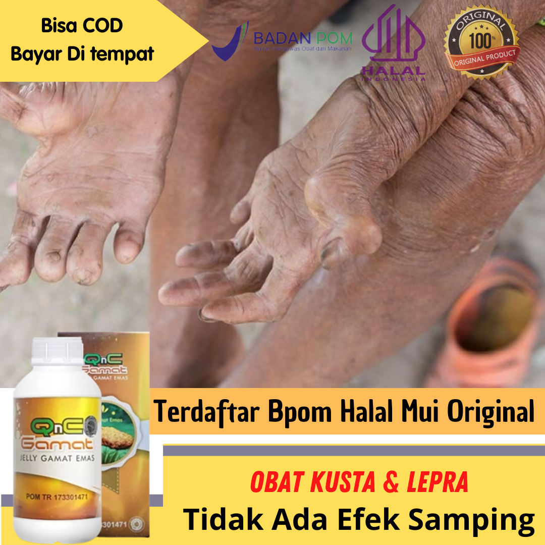 Obat kusta kering mati rasa, kusta basah, kusta kering, kusta herbal ...